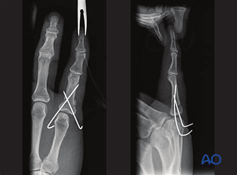 K Wire Fixation For Transverse Extraarticular Fracture Of The Proximal End Segment