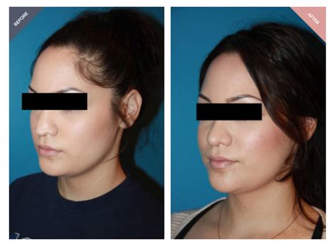 Nose Tip Refinement