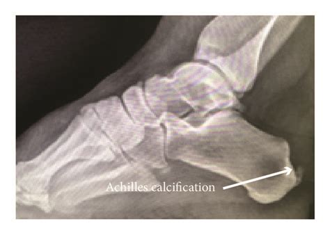 Case 3 A 40 Year Old Woman Showed Right Posterior Heel Pain For 3