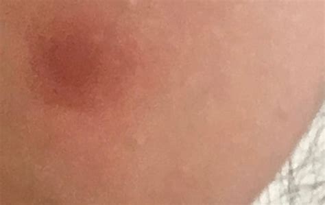 여드름 색소침착 지식in