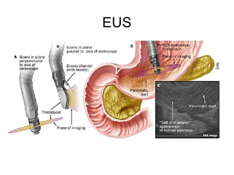 Endocsopic Ultrasound Eus