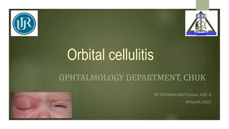 Orbital Cellulitispptx