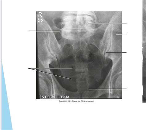 Si Joint X Ray Diagram Quizlet