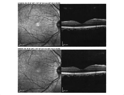 Optical Coherence Tomography Of Normal Right Eye Download Scientific Diagram