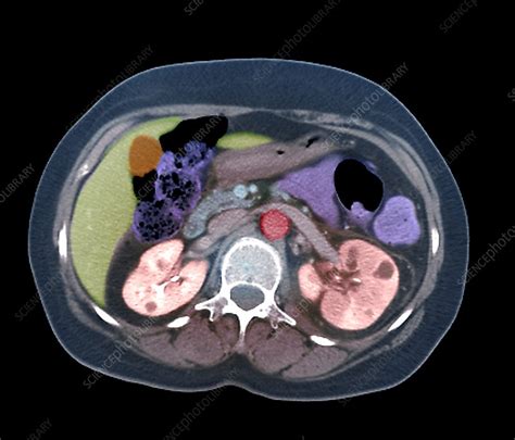 Pyelonephritis Axial Ct Scan Stock Image C047 4754 Science Photo Library