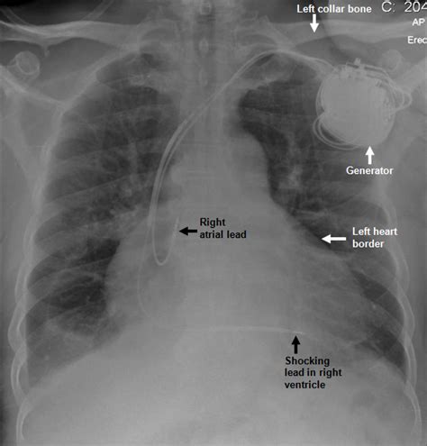 Chest X Ray Icd 10 At Gerald Jimenez Blog