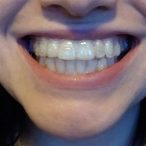 Can Invisalign Correct Midline Misalignment In Adults