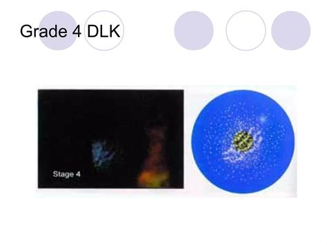 Dlk Diffuse Lamellar Keratitis After Lasik Ppt