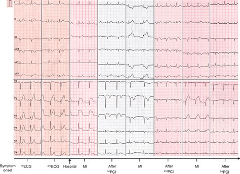 The Dynamic Changes In The Electrocardiogram ECG Of A Patient From Download Scientific