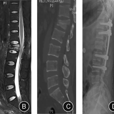 Typical Case One A 55yearold Female Patient Suffered L1 Compression Download Scientific