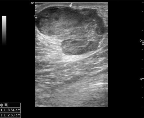 Subcutaneous Hematoma Distal Leg Radiology Case 57 Off