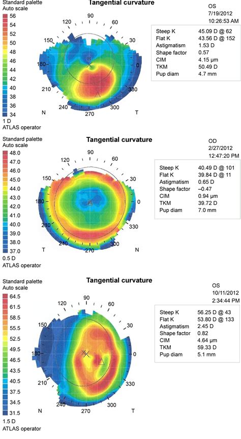 Figure From Clinical Performance Of KeraSoft IC In Irregular Corneas Semantic Scholar