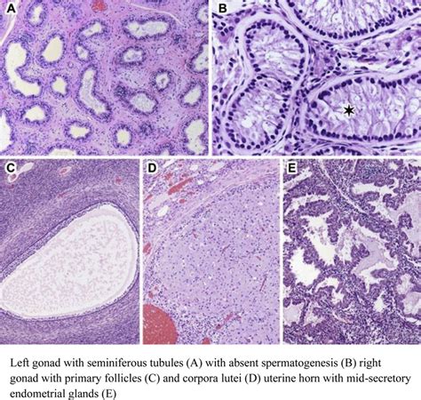 29 Ovotesticular Disorder Of Sexual Development A Case Report