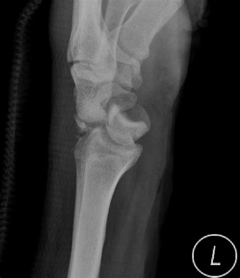 Perilunate Vs Lunate Dislocation