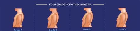In Which Stages Of Gyno Are You