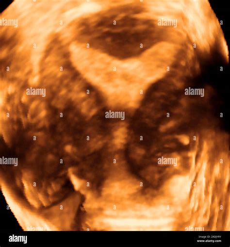 Arcuate Uterus Ultrasound Arcuate Uterus Ultrasound