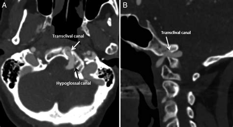 Carotid Canal Ct