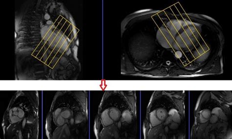 Mri Cardiac T1 Mapping T2 Mapping And T2 Mapping