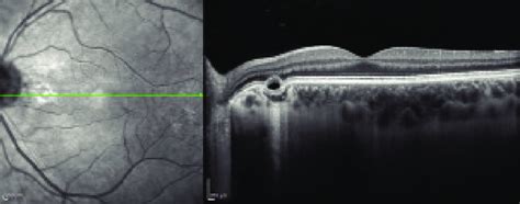 Linear Horizontal Transfoveolar Oct Scan Of Left Eye Focal Choroidal Download Scientific