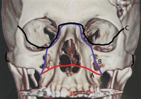 Maxillary Fracture Classification