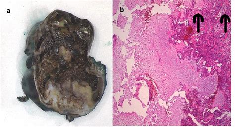 A Biopsy Specimen The Image Shows An Encapsulated And Nodular Mass