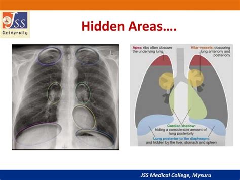 Chest X Ray Basic Interpretation Pptx