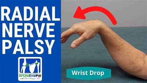 Median Nerve Palsy Splint