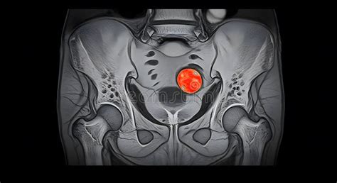 Medical Imaging Analysis Pelvis Mri Scan Showing A Tumor In The Pelvic Region Stock Illustration
