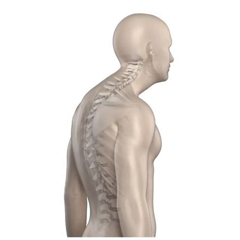 Gibbus Deformity Causes Symptoms Treatment Exercises