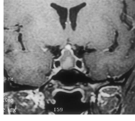 Figure 1 From Pituitary Apoplexy In Association With Lymphocytic Hypophysitis Semantic Scholar