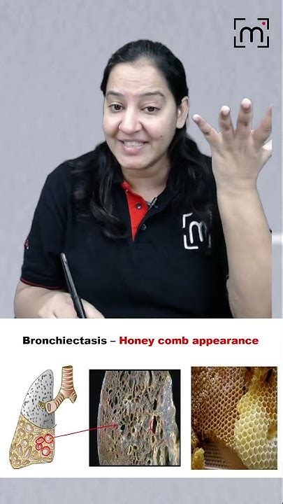Honeycomb Appearance Bronchiectasis Medlive Dr Priyanka Sachdev