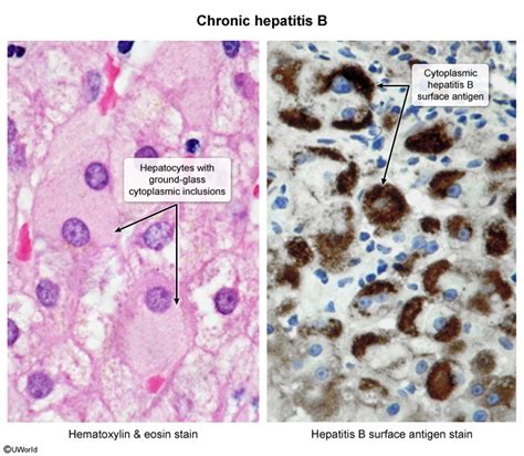 Hepatitis B Virus Hbv Infection Gastroenterology Uworld Medical