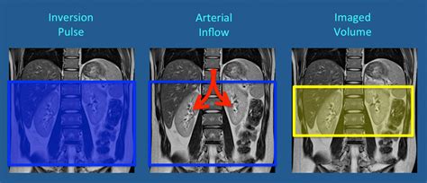 Inflow Enhanced Ssfp Questions And Answers In Mri