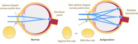 What Is A Spherical Equivalent In Myopia