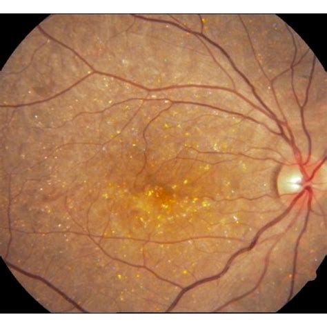 A Sd Oct Of The Right Eye Depicting The Intraretinal Cysts Outer
