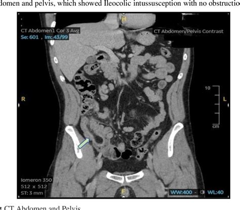 Figure 6 From Inverted Meckels Diverticulum A Case Report And Role Of