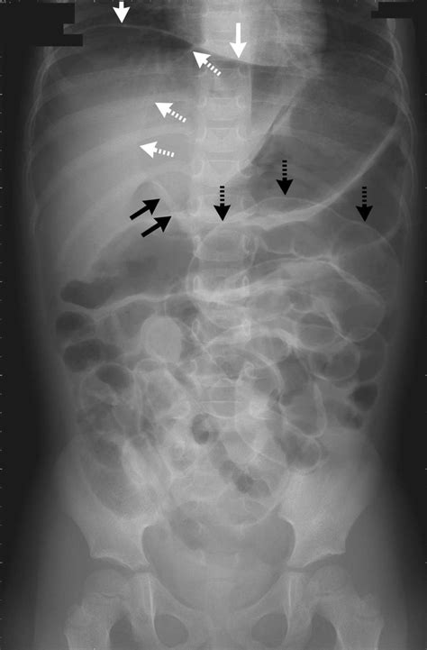 Flagellate Hyperpigmentation From Bleomycin Manual Of Medicine