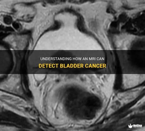 Understanding How An Mri Can Detect Bladder Cancer Medshun