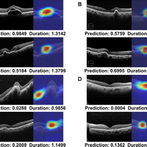 representative cases of gradient weighted class activation mapping