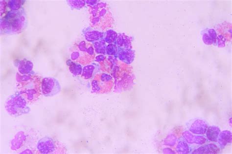 csf cell free dna superior to cytology in detecting leptomeningeal