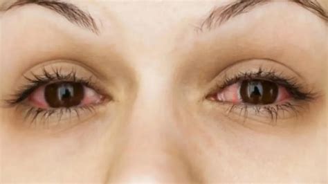Lash Extensions Itchy What Causes And How To Prevent