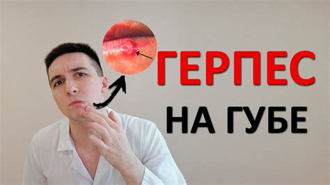Как быстро вылечить простуду на губе - 3 лучшие мази