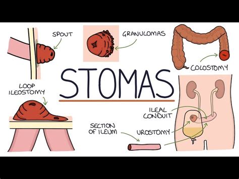 Loop Ileostomy Vs End Ileostomy