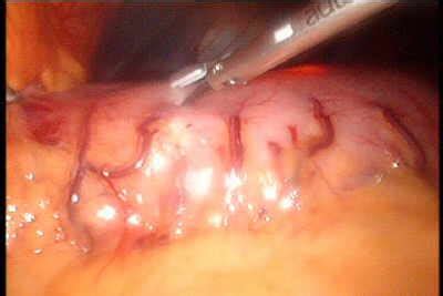 Gastrointestinal Estromal Tumor GIST The Gastrointestinalatlas Gastrointestinalatlas Com