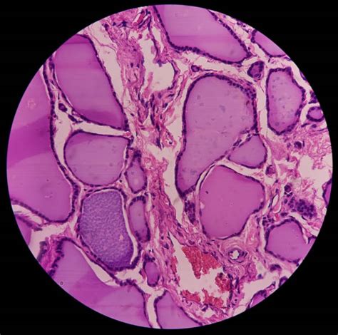 10 Bocio Multinodular Fotografías De Stock Fotos E Imágenes Libres De Derechos Istock