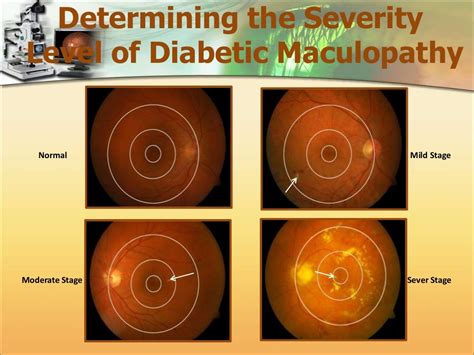 Automatic Detection Of Diabetic Maculopathy From Fundus Images Using