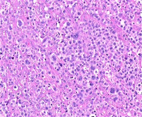 Pathology Outlines Cd45 Lca