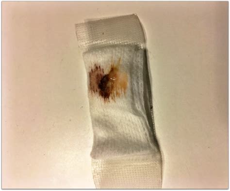 Home Nurse Causes Port Infection I Cant Catch A Inflamed And Untamed