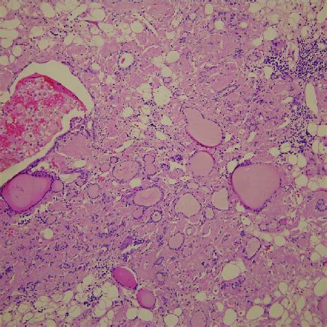 Diffusely Enlarged Thyroid Gland Download Scientific Diagram
