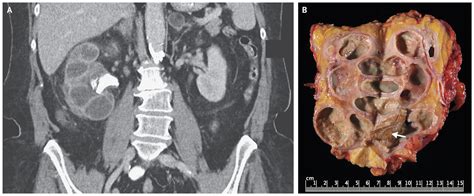 Pyelonephritis X Ray
